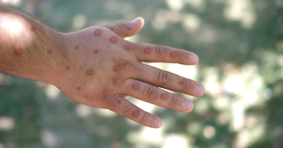 What we know so far about the first mpox case detected in the ...